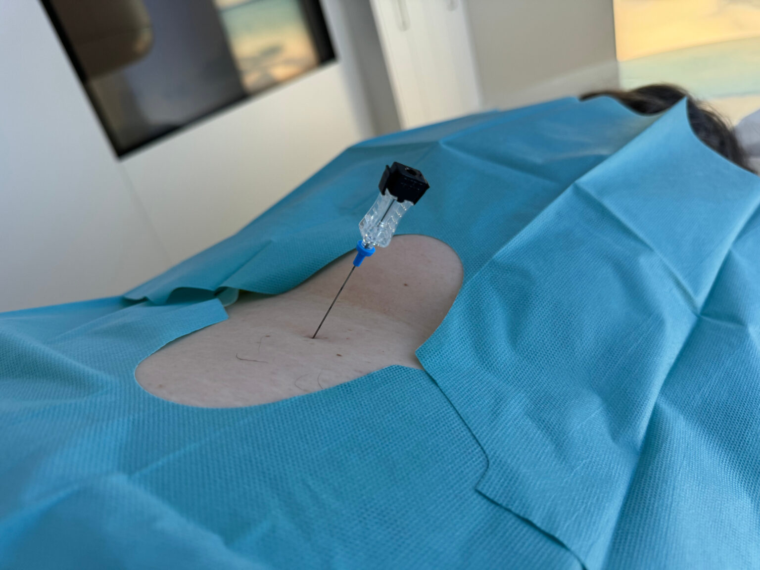 Arthrosamid® als wirksame Arthrose-Behandlung